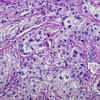 New Skin Cancer Vaccine Developed By Moderna 44 Percent Effective ...