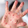 Centre Advises Strict Screening Of Passengers Amid Monkeypox Scare ...