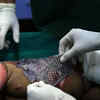 Fish Skin Is A Cheaper, Less Painful And Faster Way Of Treating Burns ...