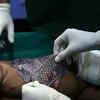 Ingenious Doctors In Brazil Are Using Fish Skin To Help Heal Burn Victims