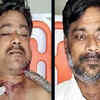 Karnataka Man Gets Impaled In Neck By 2ft Tree Branch In Freak Accident ...