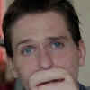 This Man Who Lost His Limbs And Lips Gets A New Set Of Lips In A First ...